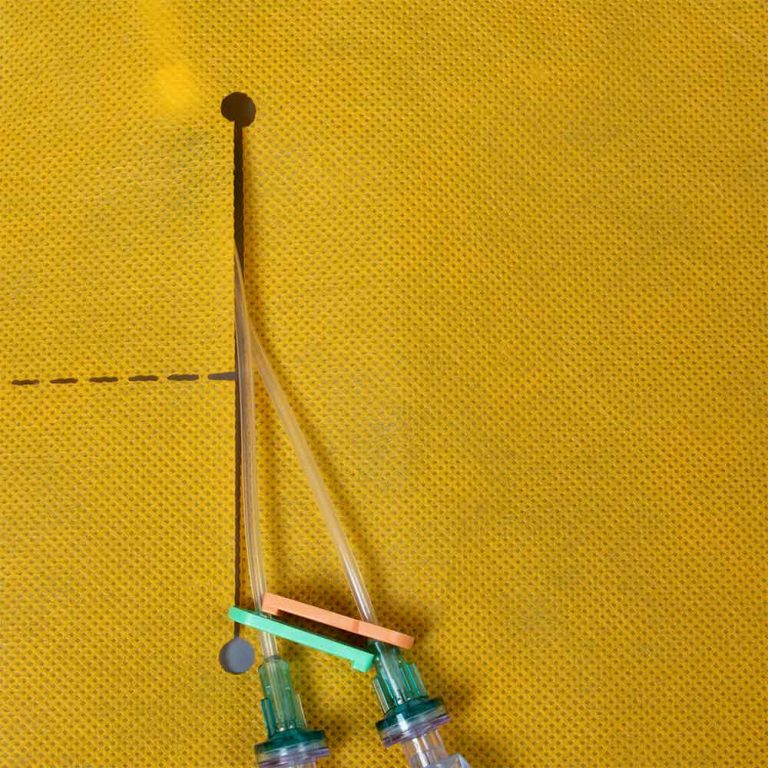 Product – Single-use Radial Access Device